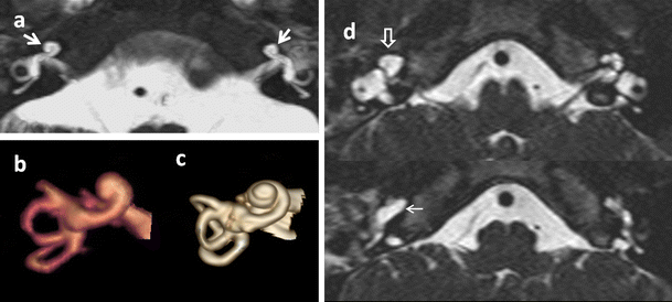 Cochlear abnormality in a case of Pallister-Hall syndrome | SpringerLink