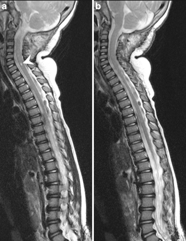 Presyrinx in a child with acquired Chiari I malformation | SpringerLink