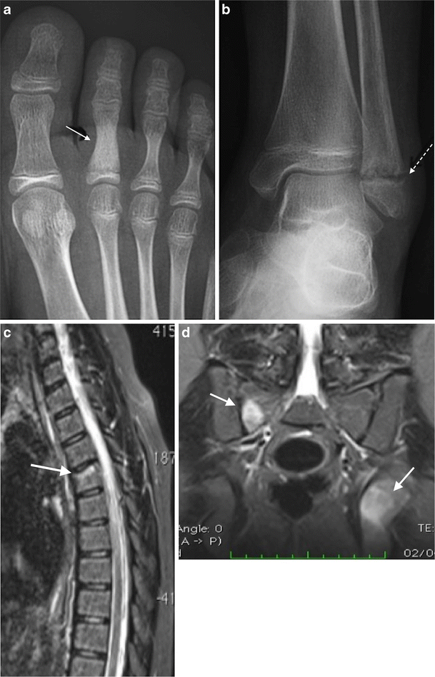 Chronic recurrent multifocal osteomyelitis (CRMO): a longitudinal case ...