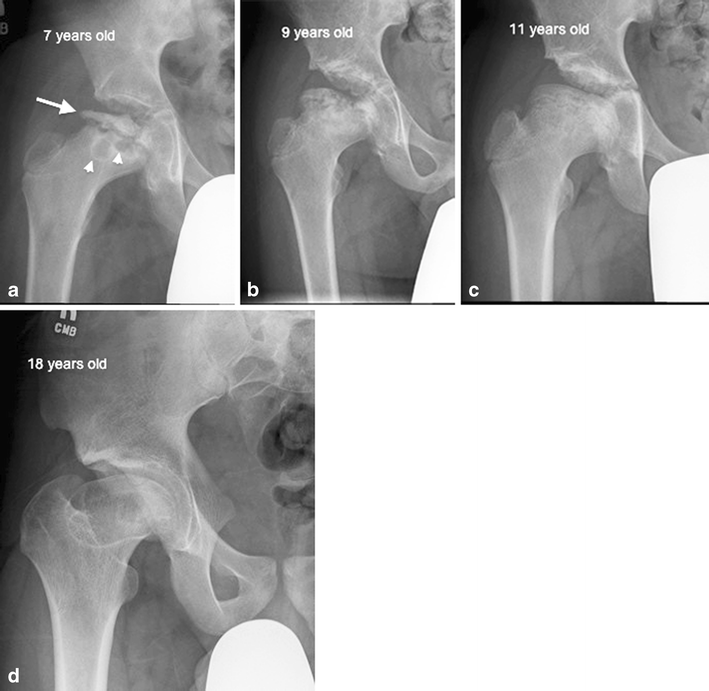 Growth arrest and leg-length discrepancy | SpringerLink