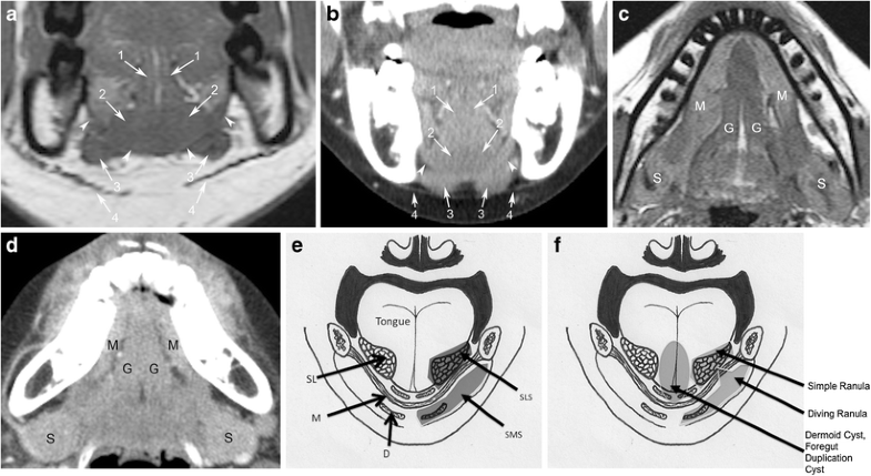 Imaging of pediatric floor of mouth lesions | SpringerLink