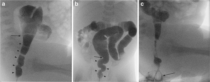 Visualisation of the rectoanal inhibitory reflex with a modified ...