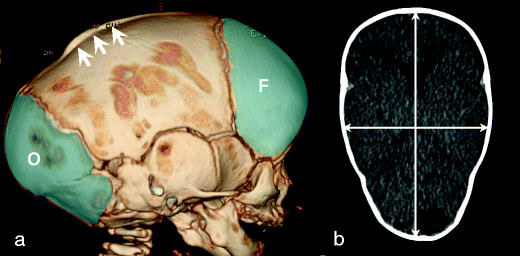 Craniosynostosis: imaging review and primer on computed tomography ...