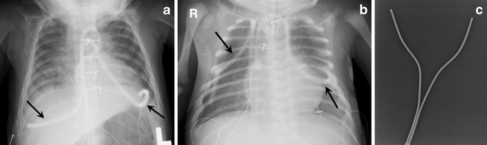 The radiographic appearance of split Blake drains: what you see is not ...