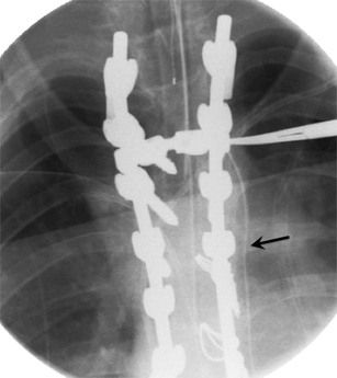 The radiographic appearance of split Blake drains: what you see is not ...
