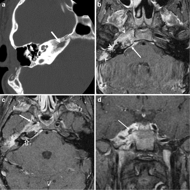 Petrous apex lesions in the pediatric population | SpringerLink