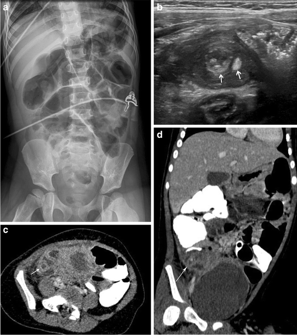 Perforated appendicitis: an underappreciated mimic of intussusception ...