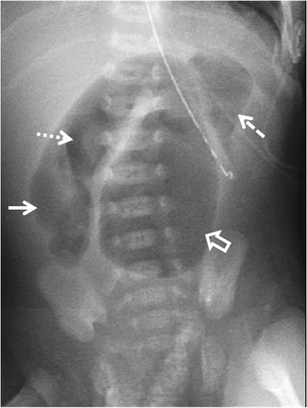 Case 1: a newborn with bilious emesis | SpringerLink