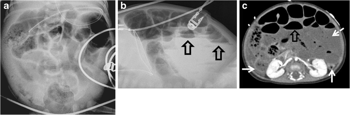 Case 1: a newborn with bilious emesis | SpringerLink