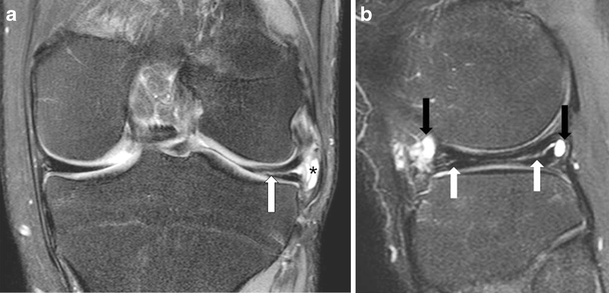 Meniscal pathology in children: differences and similarities with the ...