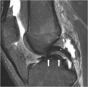 Meniscal pathology in children: differences and similarities with the ...