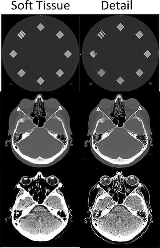 Iterative reconstruction: how it works, how to apply it | SpringerLink