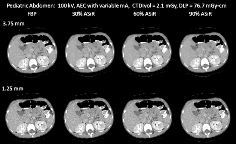 Iterative reconstruction: how it works, how to apply it | SpringerLink
