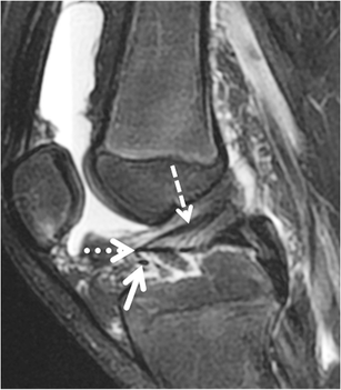 Avulsion fractures of the pediatric knee | SpringerLink