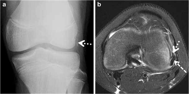 Avulsion fractures of the pediatric knee | SpringerLink