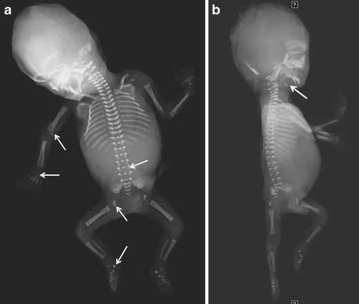 Foetal radiography for suspected skeletal dysplasia: technique, normal ...