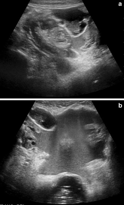The challenging ultrasound diagnosis of perforated appendicitis in ...