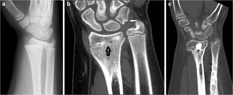 Imaging of physeal bars in children | SpringerLink