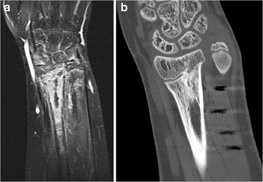 Imaging of physeal bars in children | SpringerLink