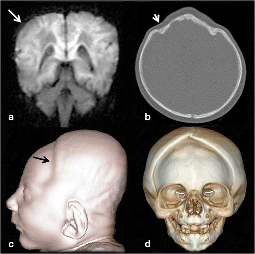 Skull base development and craniosynostosis | SpringerLink