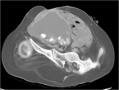 The role of imaging in pediatric bladder augmentation | SpringerLink
