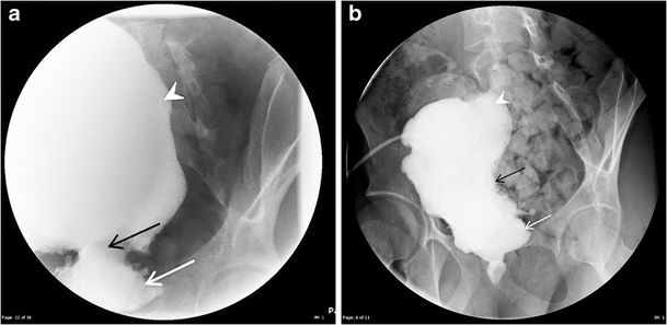 The role of imaging in pediatric bladder augmentation | SpringerLink