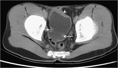 The role of imaging in pediatric bladder augmentation | SpringerLink
