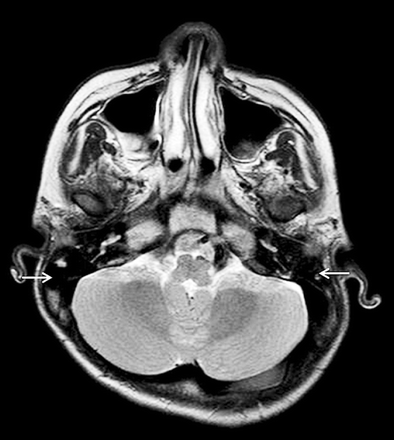 Incidental mastoid opacification in children on MRI | SpringerLink