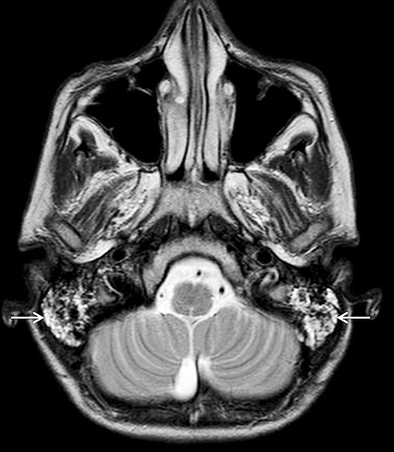 Incidental mastoid opacification in children on MRI | SpringerLink