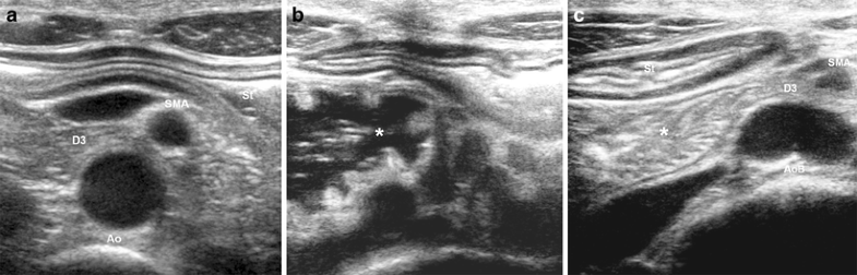 Ultrasound of the duodenum in children | SpringerLink
