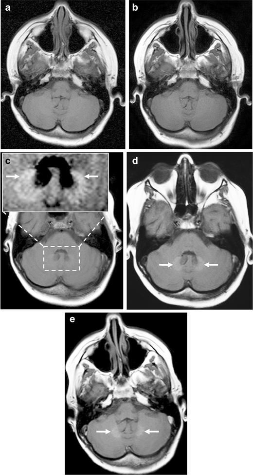 Increased signal intensities in the dentate nucleus and globus pallidus ...