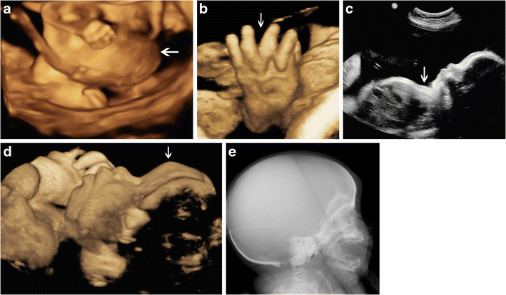 Evaluating skeletal dysplasias on prenatal ultrasound: an emphasis on ...