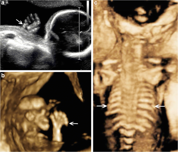 Evaluating skeletal dysplasias on prenatal ultrasound: an emphasis on ...