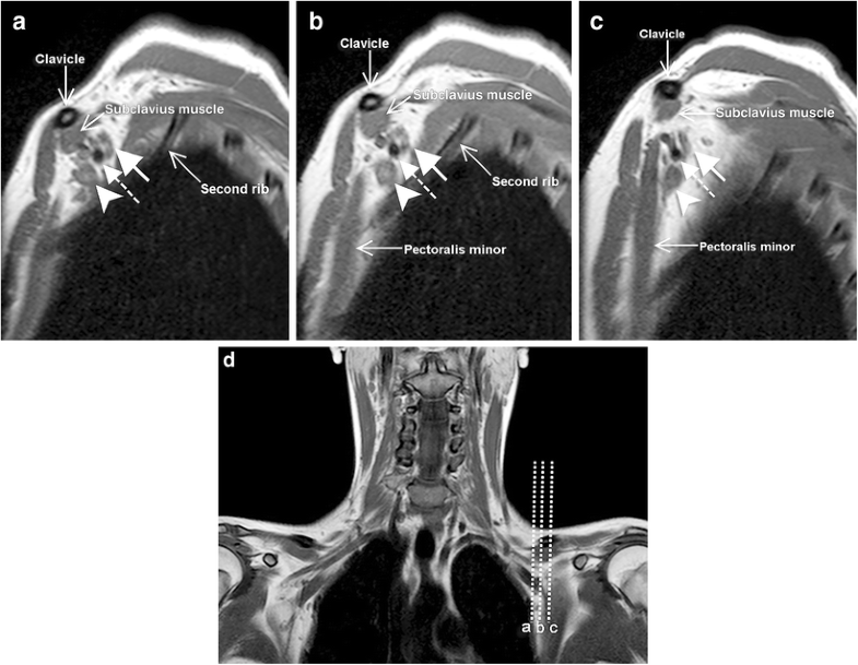 MRI of thoracic outlet syndrome in children | SpringerLink
