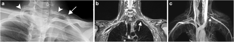 MRI of thoracic outlet syndrome in children | SpringerLink