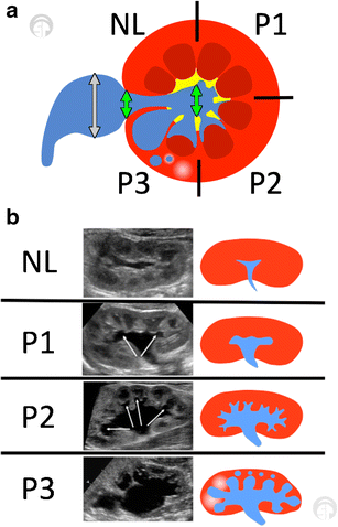 Classification of pediatric urinary tract dilation: the new language ...