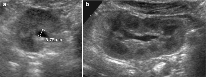 Classification of pediatric urinary tract dilation: the new language ...