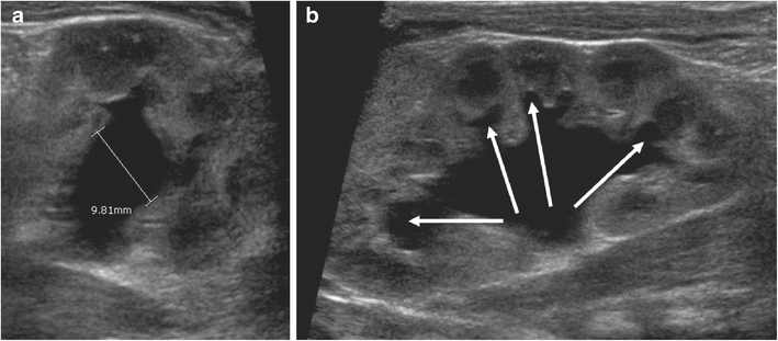 Classification of pediatric urinary tract dilation: the new language ...