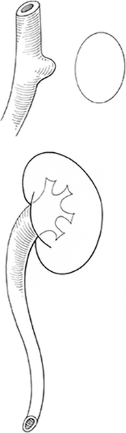 The duplicated collecting system of the urinary tract: embryology ...