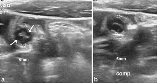 Ultrasound of the pediatric appendix | SpringerLink