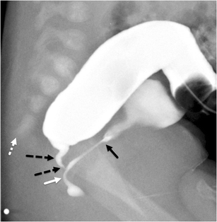 Augmented-pressure distal colostogram: the most important diagnostic ...