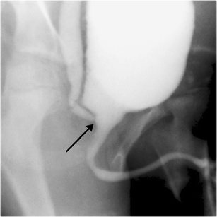 Augmented-pressure distal colostogram: the most important diagnostic ...