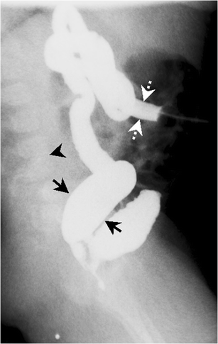 Augmented-pressure distal colostogram: the most important diagnostic ...