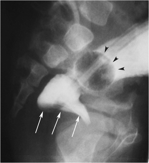Augmented-pressure distal colostogram: the most important diagnostic ...