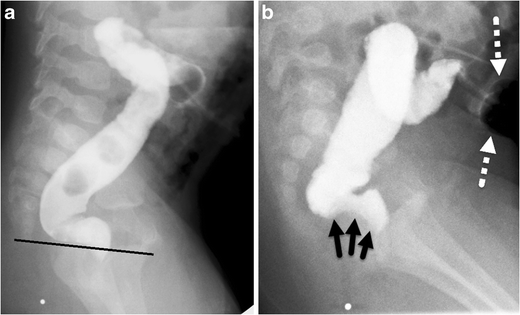 Augmented-pressure distal colostogram: the most important diagnostic ...