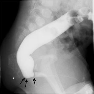 Augmented-pressure distal colostogram: the most important diagnostic ...