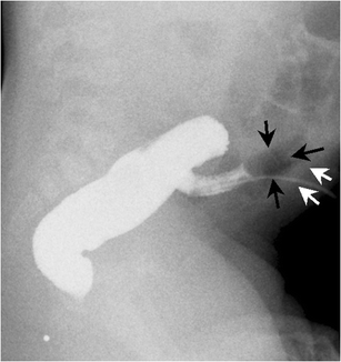 Augmented-pressure distal colostogram: the most important diagnostic ...