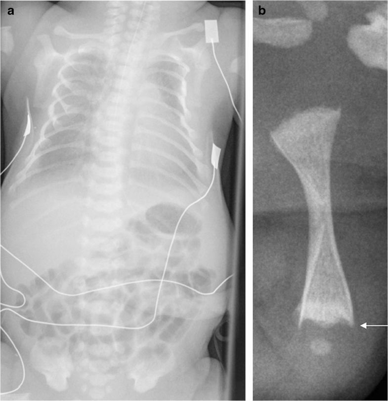 Differential diagnosis of perinatal hypophosphatasia: radiologic ...