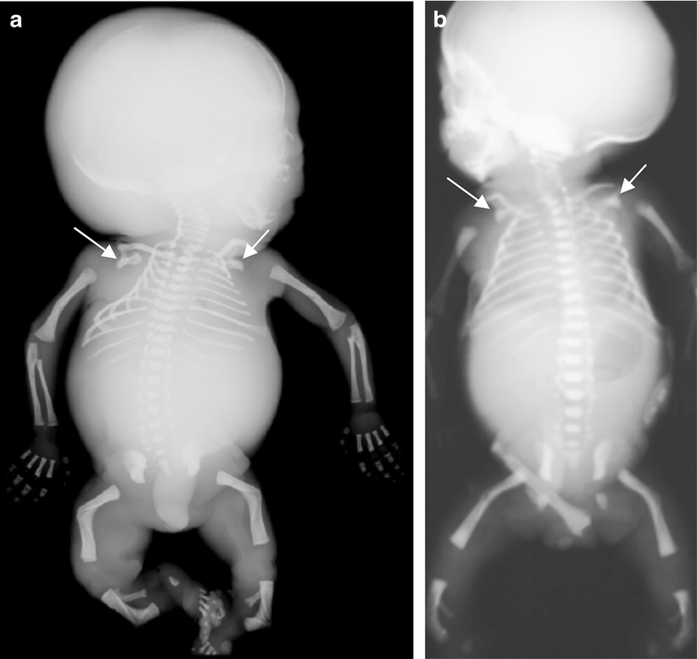 Differential diagnosis of perinatal hypophosphatasia: radiologic ...