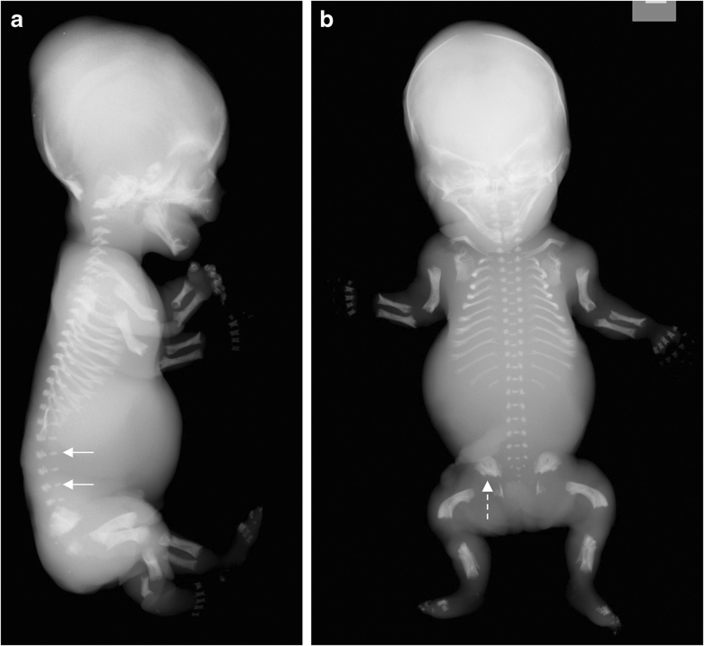Differential diagnosis of perinatal hypophosphatasia: radiologic ...